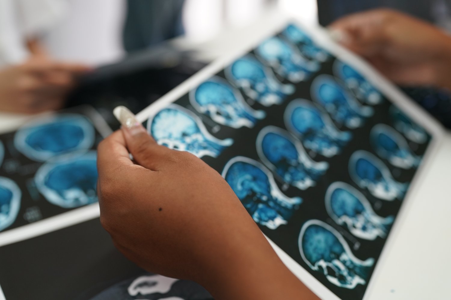 Chronic Traumatic Encephalopathy (CTE): Symptoms, Causes, Stage | Your ...